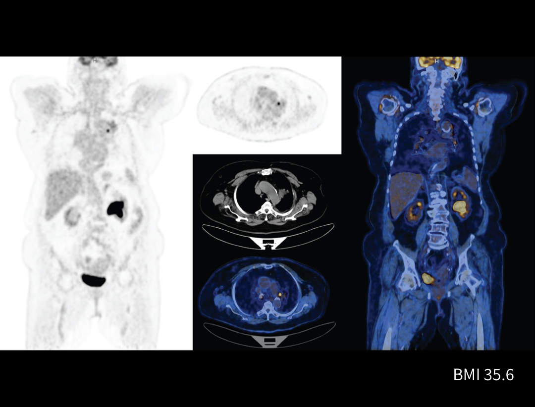 uMI 550: Digital PET/CT | United-Imaging Healthcare